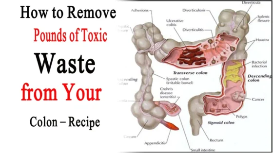 How To Remove 5 To 14 Pounds Of Toxic Waste From Your Colon (1 Pound ...