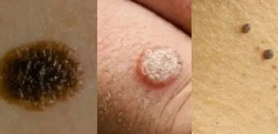 New Hack: How To Freeze Moles, Warts & Sunspots Off Your Body For Less ...