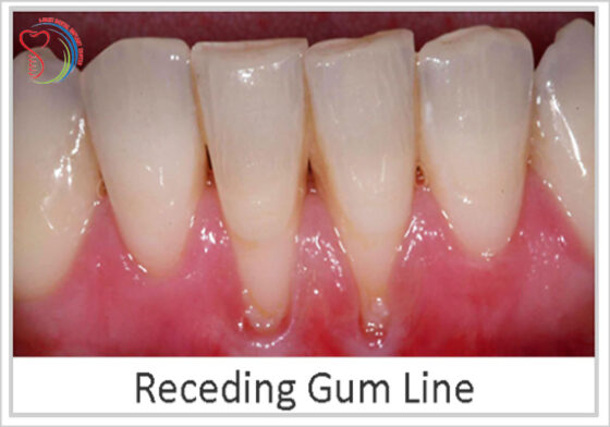 How To Protect and Preserve Your Gums From Receding Gum Disease And Why ...